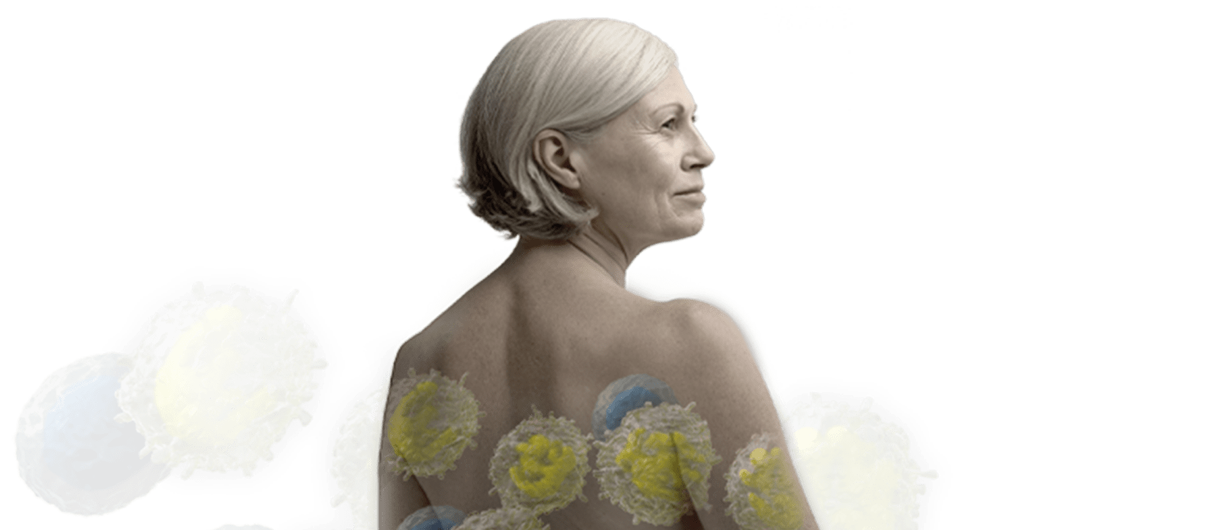 Cutaneous T-cell lymphoma (CTCL) Assessments | Inside CTCL