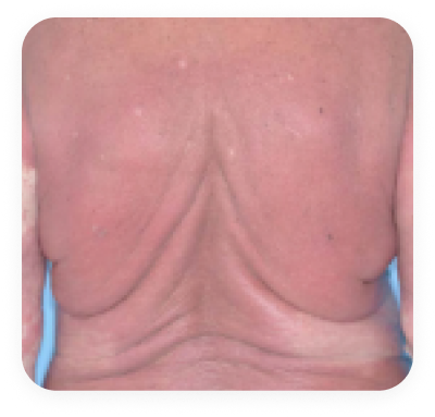 Sézary Syndrome (SS) | Inside CTCL