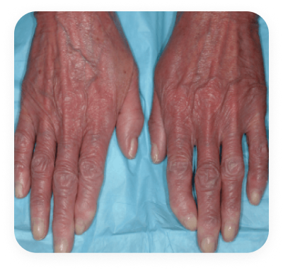 Sézary Syndrome (SS) | Inside CTCL