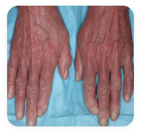 Sézary Syndrome (SS) | Inside CTCL